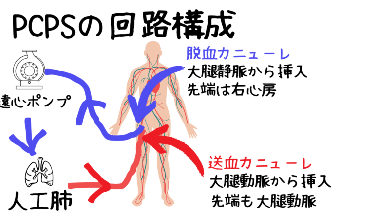 急変時に慌てない！PCPS導入の流れと臨床工学技士の役割を徹底解説 | みんなのMEセンター