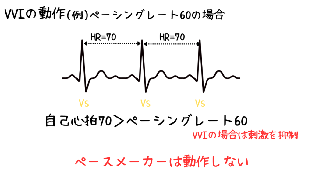 ペースメーカーの基本設定 VVIについて | みんなのMEセンター
