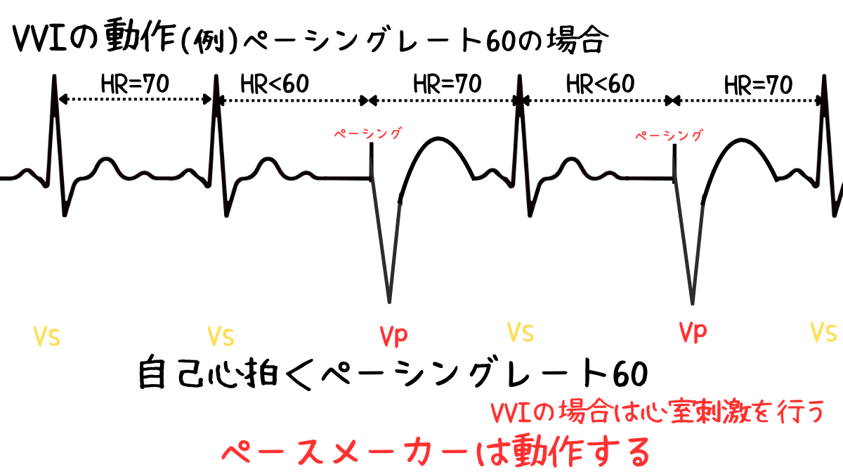 ペースメーカーの基本設定 VVIについて | みんなのMEセンター