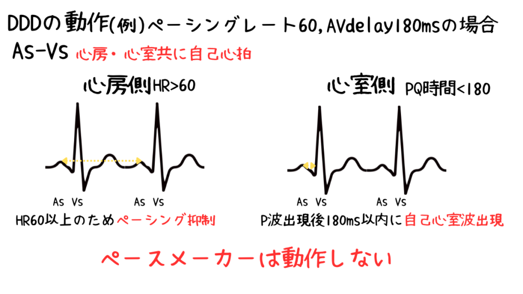 ペースメーカーの基本設定 DDDについて | みんなのMEセンター