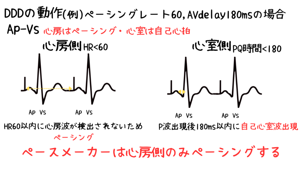 ペースメーカーの基本設定 DDDについて | みんなのMEセンター