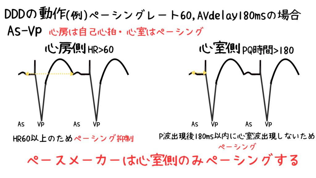 ペースメーカーの基本設定 DDDについて | みんなのMEセンター