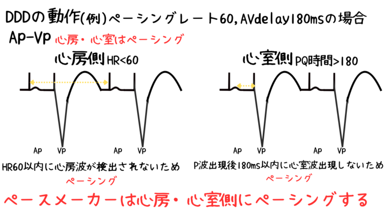ペースメーカーの基本設定 DDDについて | みんなのMEセンター
