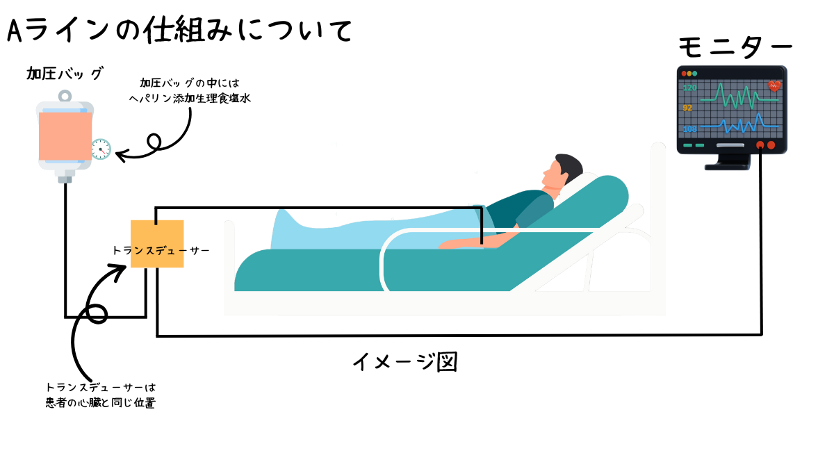 絶対に知っておきたい ICUでのAラインについて | みんなのMEセンター