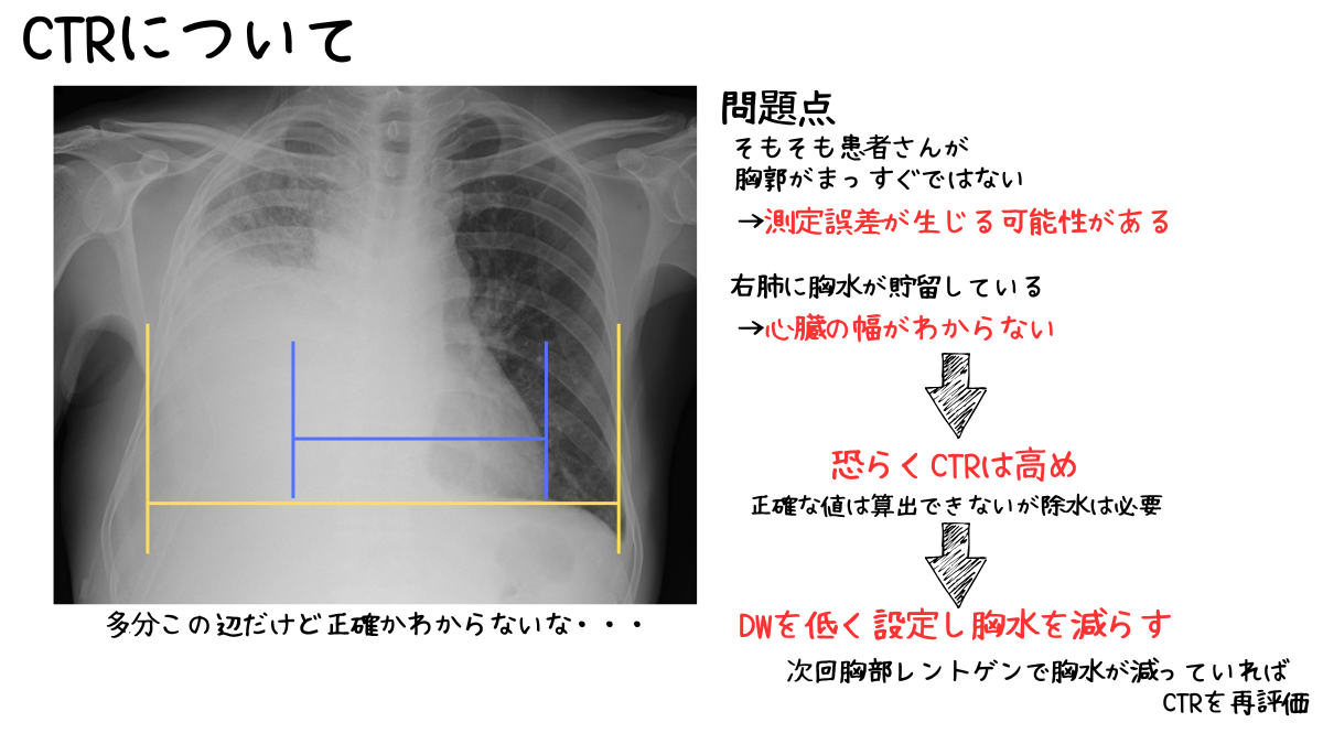 透析治療には欠かせない重要指標 DW,CTRについて | みんなのMEセンター