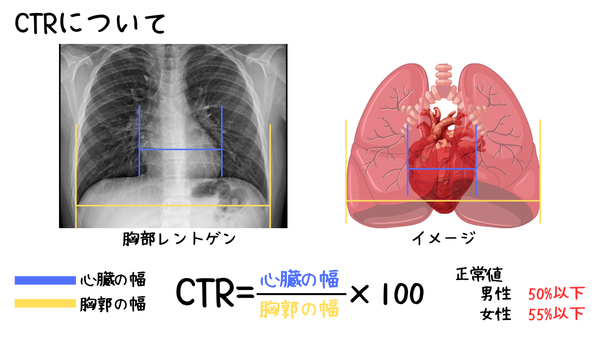 透析治療には欠かせない重要指標 DW,CTRについて | みんなのMEセンター