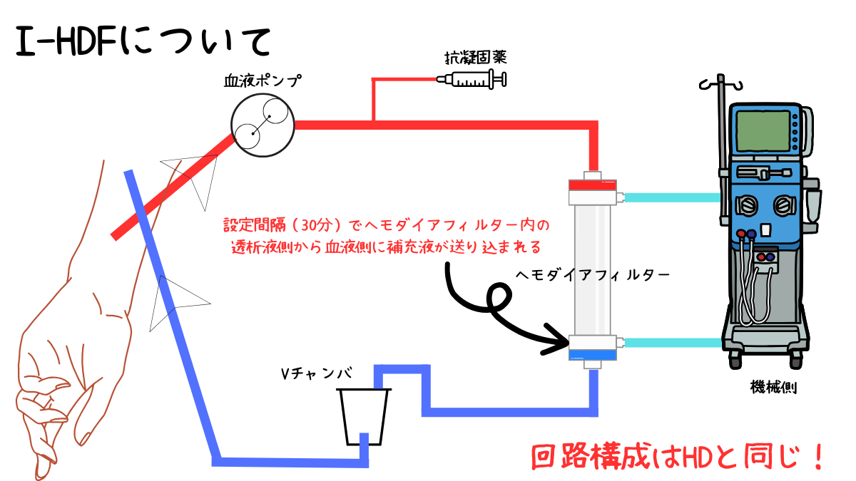 HD vs OHDF vs I-HDF：臨床工学技士が知っておくべき違いとポイント | みんなのMEセンター