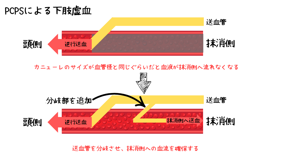 PCPS導入後に影響！カニューレと抹消送血について | みんなのMEセンター