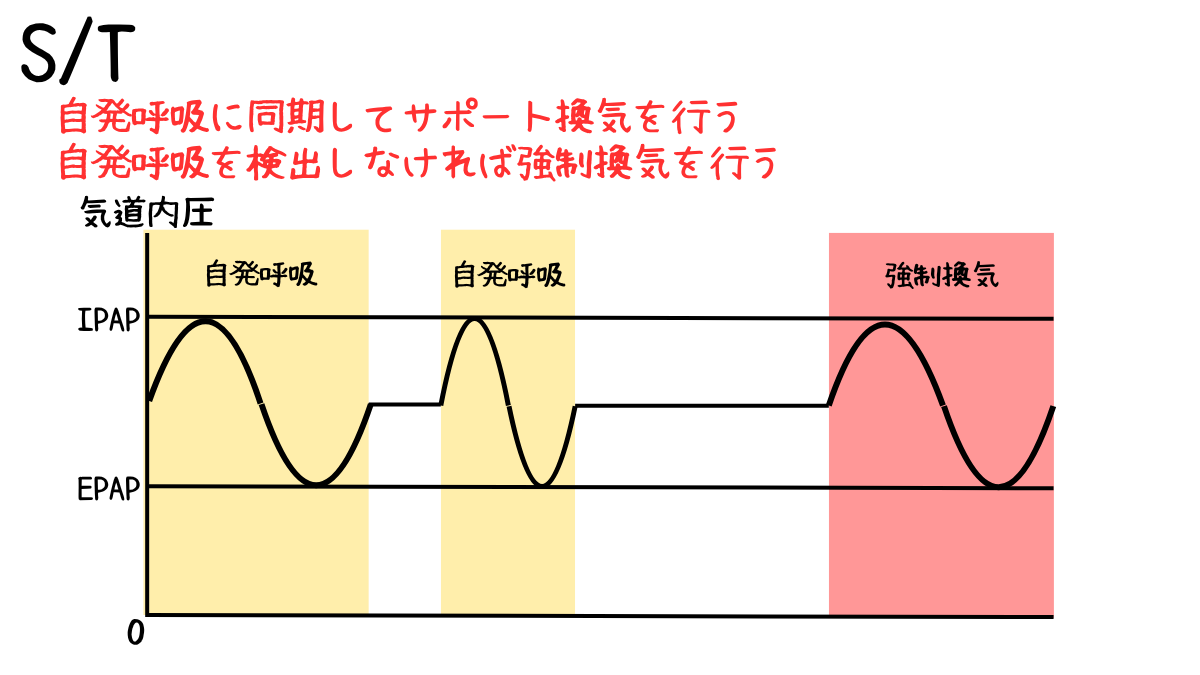 臨床工学技士のためのNPPV入門：設定のコツと心不全治療のポイント | みんなのMEセンター