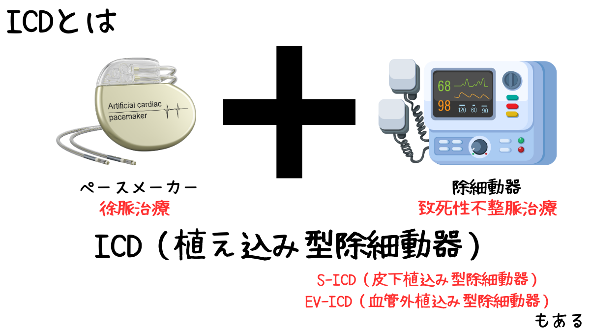 植込み型除細動器（ICD）のすべて：仕組みから適応疾患まで徹底解説 | みんなのMEセンター