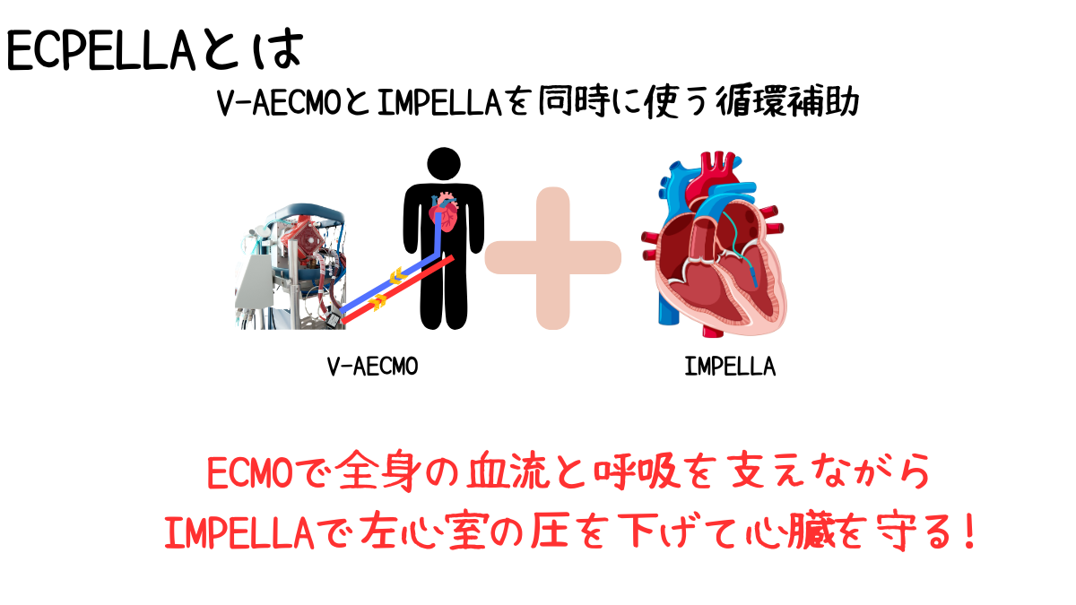 ECPELLAの基礎から離脱戦略まで：ECMOとIMPELLA併用を正しく理解するための実践ガイド | みんなのMEセンター
